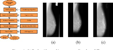 Figure 1 From Breast Cancer Detection In Mammogram Images Exploiting