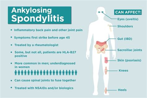 Ankylosing Spondylitis Patient