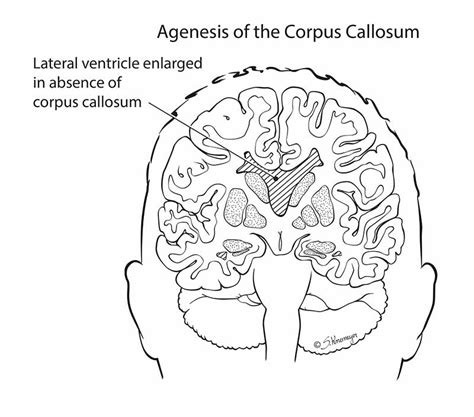 Corpus Callosum Funktion