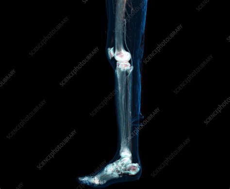 Leg Ct Scan Stock Image F0372751 Science Photo Library