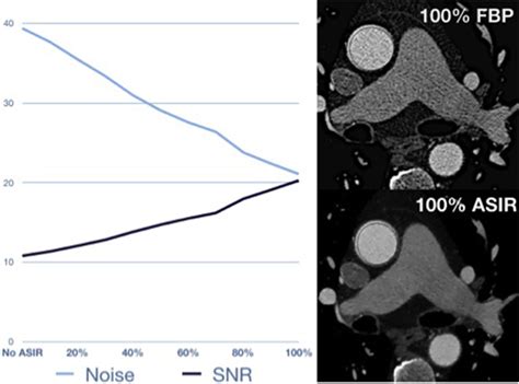Image Reconstruction In Cardiovascular Ct Part 2 Iterative Reconstruction Potential And