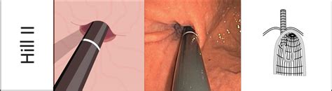 Hill Classification 1898 Art Of Surgery