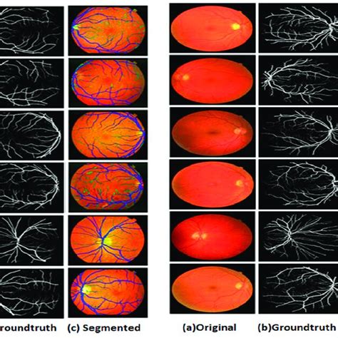 Vessel Segmentation Using Improved Woa For Stare Left And Drive