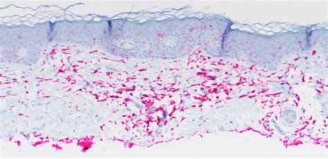 Patch Stage Mycosis Fungoides With An Unusual Clinical Appearance