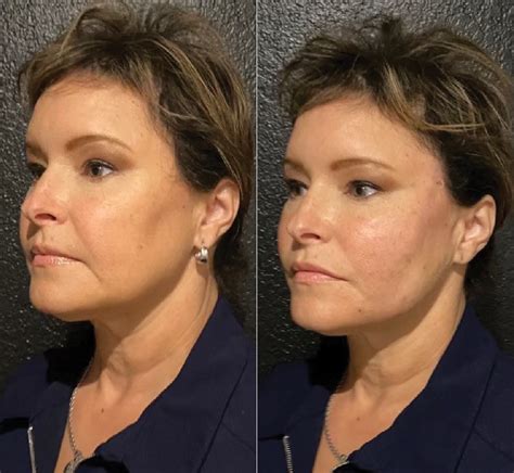 Pdo Threads In Mahattan Hydration Iv Lounge And Med Spa And Concierge Med Lounge