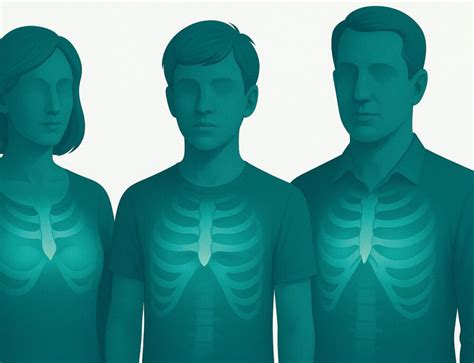 Pectus Excavatum In Women Symptoms Causes And Treatment