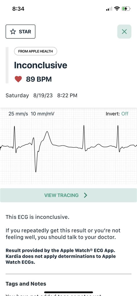 Inverted Signal On Ekg Rafib Inverted Signal On Ekg Rafib