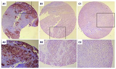 The Expression Of Melk Protein In 101 Hcc Tissues Using Tma Array A1