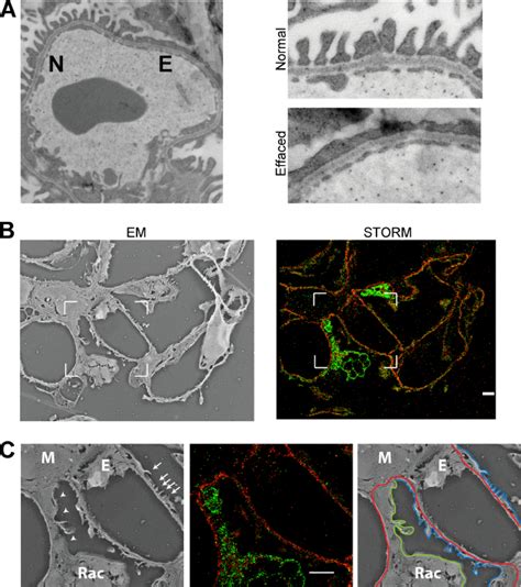 Egfpca Rac1 Expression In Podocytes Is Associated With Foot Process