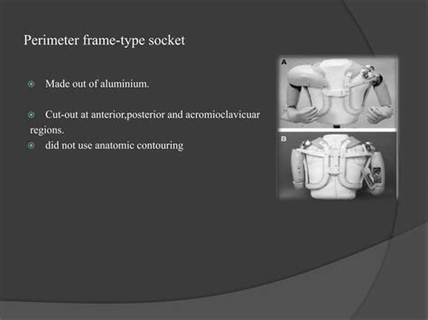 Socket Variants In Upper Extremity Prosthesis Pptx1 PPTX