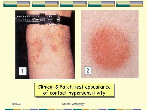 ppt hypersensitivity reactions powerpoint presentation free download