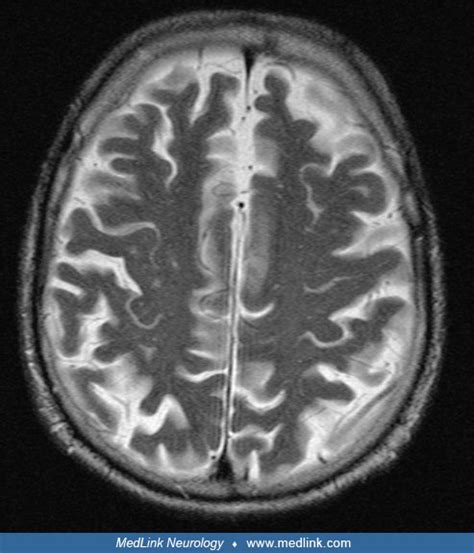 Mri Brain Abnormal