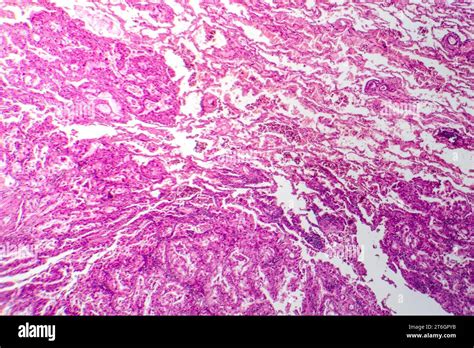 Photomicrograph Of Lung Cancer Tissue Revealing Malignant Cells And