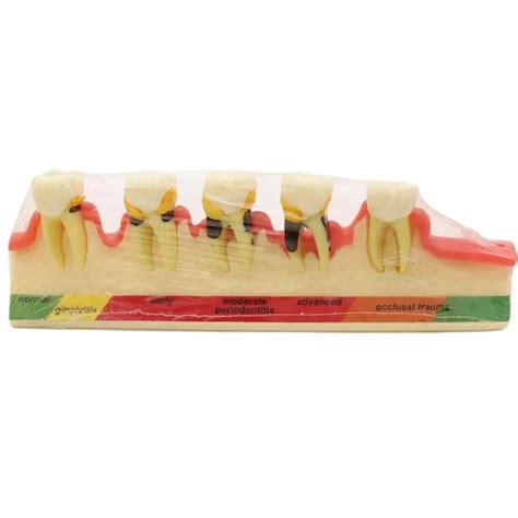 Teeth Periodontal Disease Model Dental Caries Breakdown Display