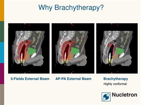 PPT Introduction To Brachytherapy PowerPoint Presentation Free