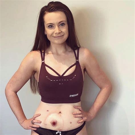 Ileostomy Bag