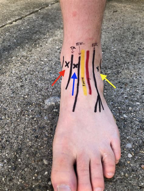 Mastering Minor Care Ankle Arthrocentesis — Taming The Sru