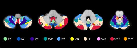Figure 1 From Cerebellar Dysconnectivity In Schizophrenia And Bipolar Disorder Is Associated