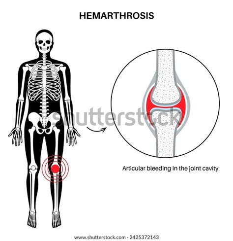 Hemarthrosis Disease Medical Poster Bleeding Inside Stock Vector Royalty Free 2425372143