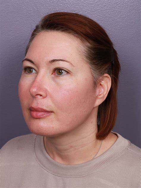 Buccal Fat Removal Before And After 63032 Mps