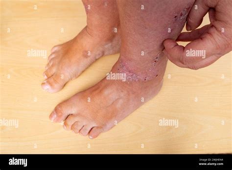 Rash Hives Itchy Skin On Legs Inflammation And Medical Allergies