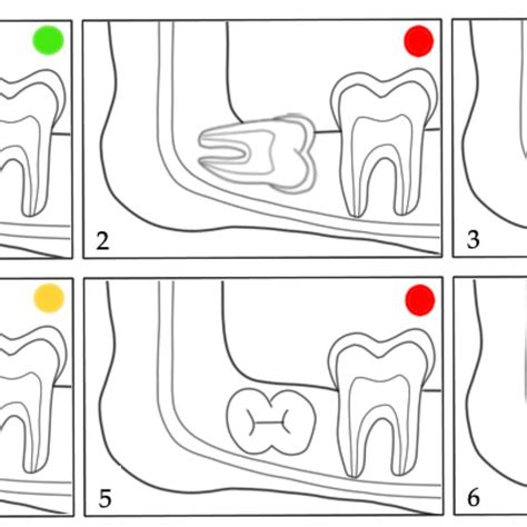 Winters Classification For The Inclination Of The Mandibular M3 Download Scientific Diagram