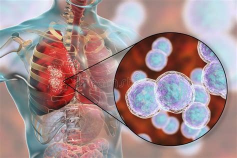 Lung Infection Caused By Bacteria Mycoplasma Pneumoniae Stock