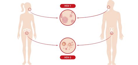 Mindray Launches High Sensitivity And High Specificity Hsv Assays Mindray