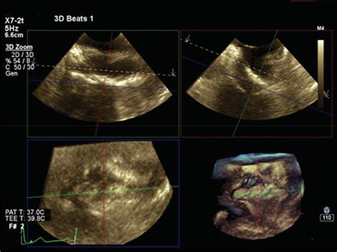 The 3d Transesophageal Echocardiography Shows A Multiplanar