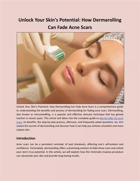 Ppt Unlock Your Skins Potential How Dermarolling Can Fade Acne