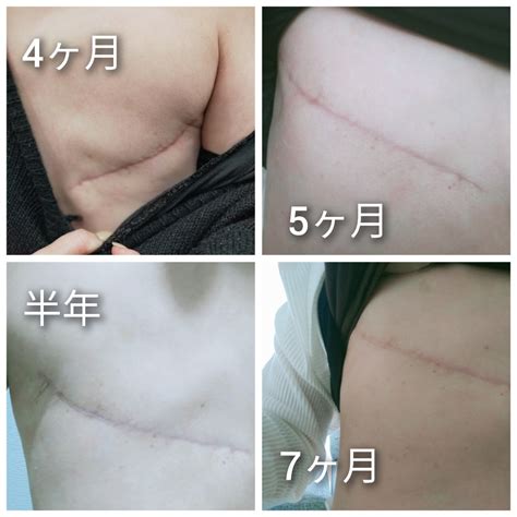 乳がん全摘手術の傷の経過※画像あり 乳がん※トリプルネガティブ※日記