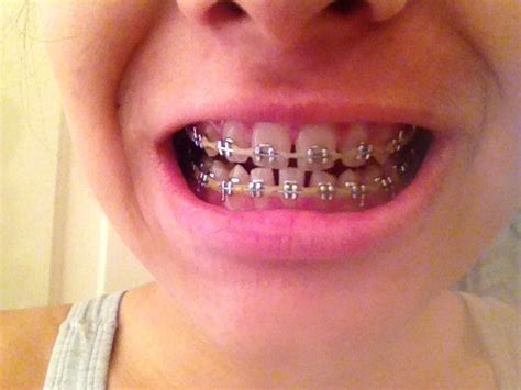 Elastics For Overbite