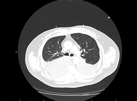 Primary Pleural Extranodal Marginal Zone Lymphoma Presenting As