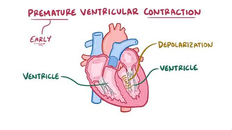 Premature Ventricular Contraction Video And Anatomy Osmosis