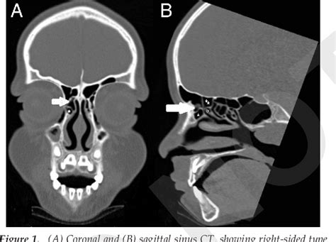 Figure 1 From Computed Tomographic Analysis Of Frontal Recess Cells In Pediatric Patients
