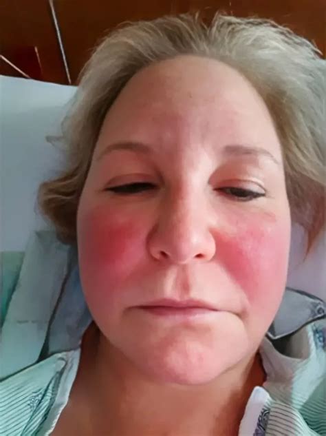 Penicillin Allergy Symptoms Risks And Alternatives