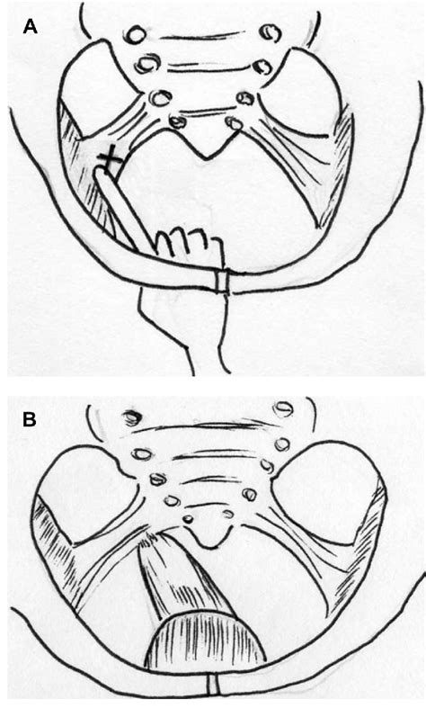 Table 1 From Modern Role Of Sacrospinous Ligament Fixation For Pelvic