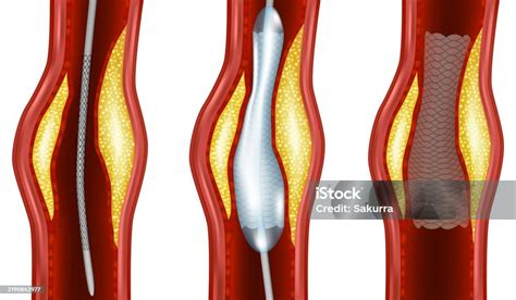 Ilustración De Ilustración Del Procedimiento De Angioplastia