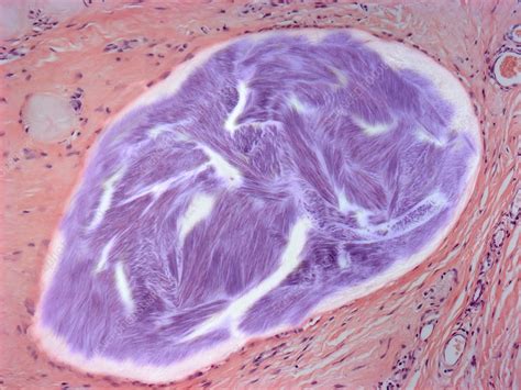 Gout Light Micrograph Stock Image C0216139 Science Photo Library