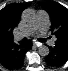 000 Tree In Bud Sign Lungs