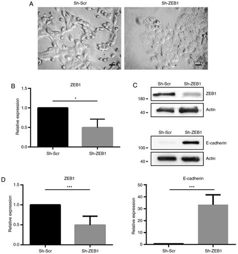 Knockdown Of Zeb1 Reverses Cancer Stem Cell Properties In Prostate