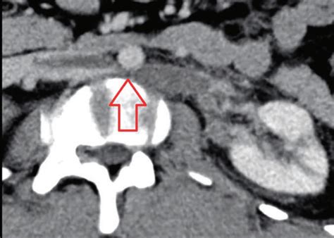 Selected Axial Computed Tomography Indicating Retroaortic Course Of Download Scientific Diagram