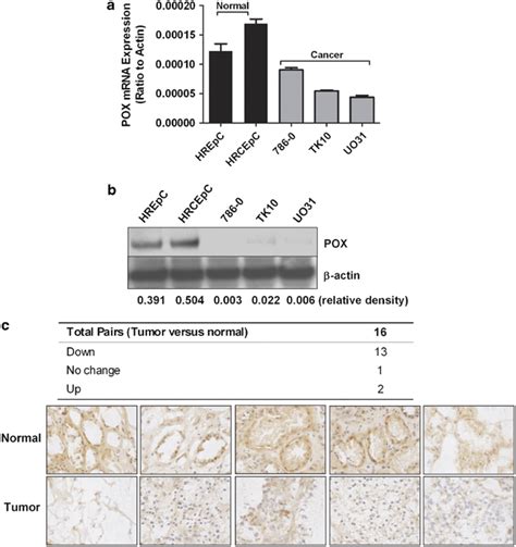 Reduced Pox Expression In Renal Cancer Cell Lines And Human Renal