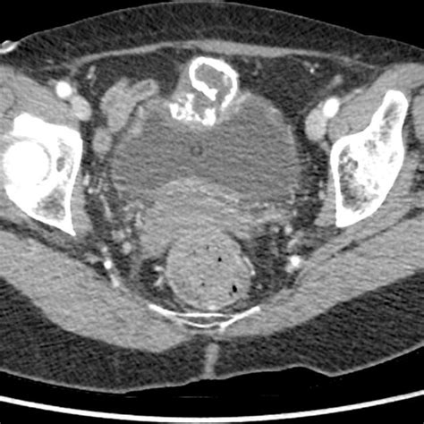 Ct Scan Showing The Calcified Lesion Arising Within The Bladder Wall Download Scientific Diagram