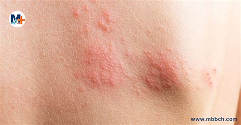 Cholinergic Urticaria MBBCH Health Encyclopedia