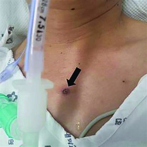 Photograph Of The Patients Eschar On The Anterior Chest Arrow