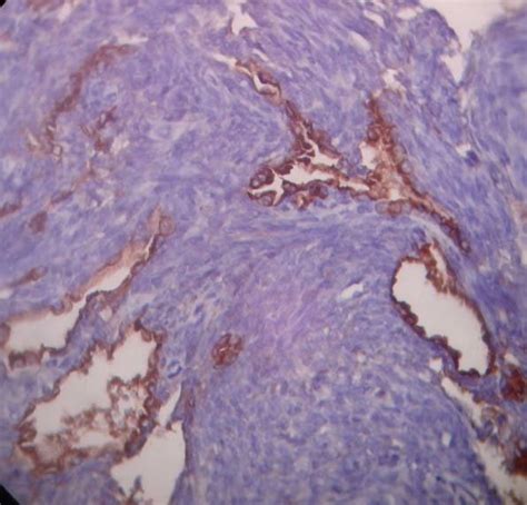A Synovial Sarcoma Exhibiting A Classic Biphasic Spindle Cell And