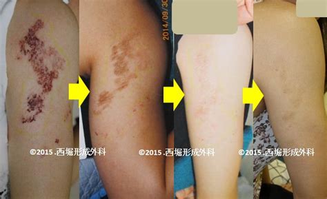 単純性血管腫 あざ治療の専門クリニック西堀形成外科
