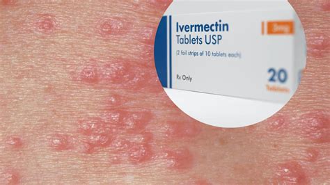 Scabies Treatment Howstuffworks