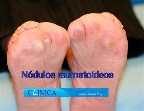 Pie Reumático Artritis Reumatoide